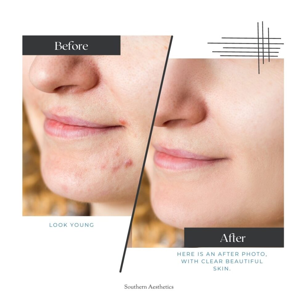 How A Carbon Laser Facial Can Help Get Glass Skin | Southern Aesthetics
